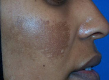 Melasma/Chloasma – Dr Brad's Laser and Cosmetic Clinic, Bristol
